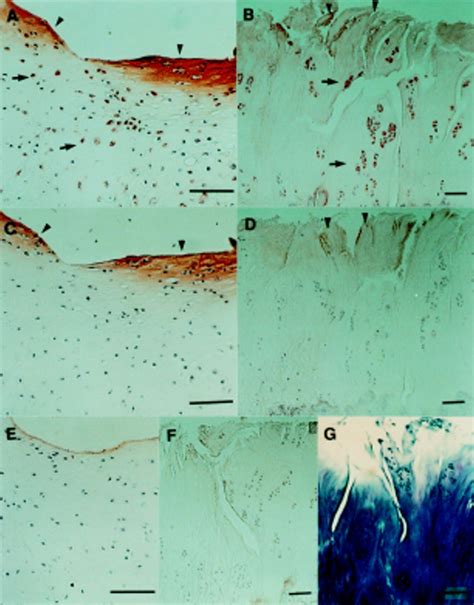 Complement C1s Activation In Degenerating Articular Cartilage Of