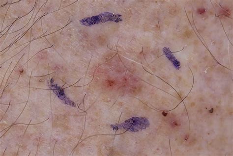 Understanding Basal Cell Carcinoma Bcc Symptoms And Treatment