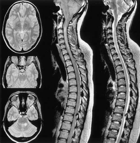 Multiple Sclerosis Mri Spine