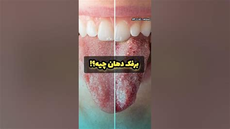 برفک دهان چیه؟shortvideo Shorts Shortpodcast دهانبیماری Youtube