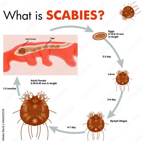 Scabies What Is Scabies Stock Vector Adobe Stock