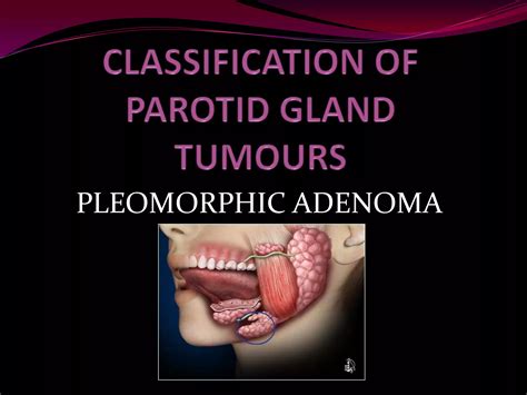 Pleomorphic Adenoma Pptx