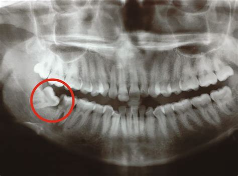 Abscessed Wisdom Tooth Xray