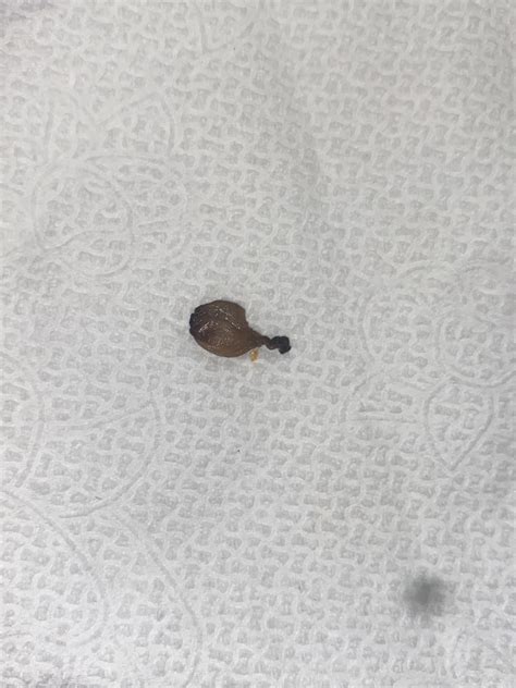 Pea Sized Flesh Colored Mass Found In Underwear Raskdocs