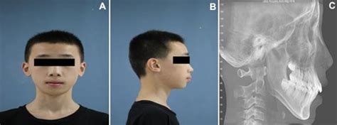 Pretreatment Extra Oral Photographs And Lateral Cephalometric