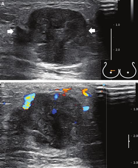 A A 34 × 23 Cm Irregularand Heterogeneous Echoic Mass Arrows With