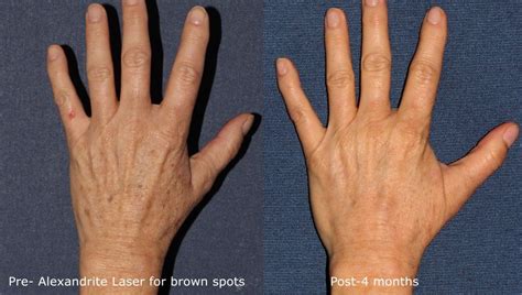 Black Dots On Hands