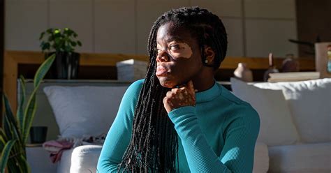 How Vitiligo Progresses Your Faqs