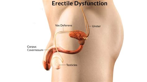 Erectile Dysfunction Causes Symptoms Methods Of Treatment Erectile