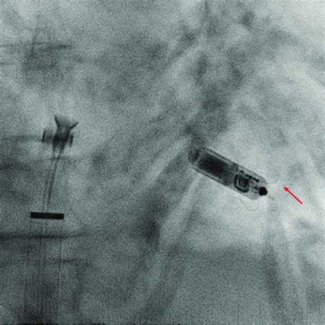 Leadless Pacemaker System Extraction Orange Arrow Shows A Tangle Of