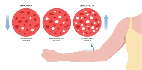 Cancar Over 76 Royalty Free Licensable Stock Vectors And Vector Art