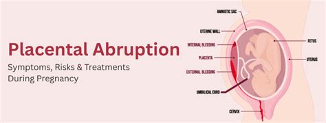 Placental Abruption Symptoms Risks And Treatments During Pregnancy