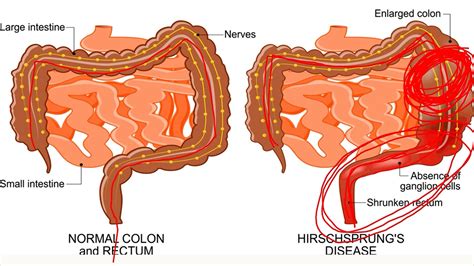 Hirschsprung Disease