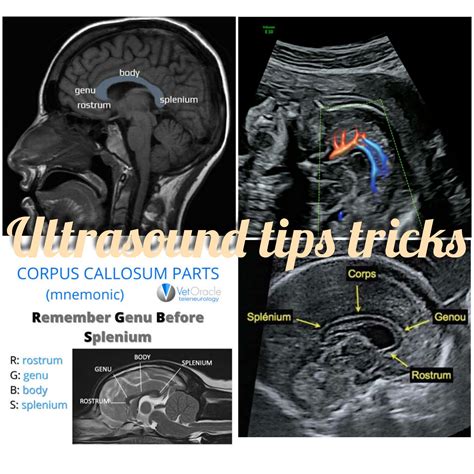 Ultrasound The Corpus Callosal Artery Is Identified Branching From