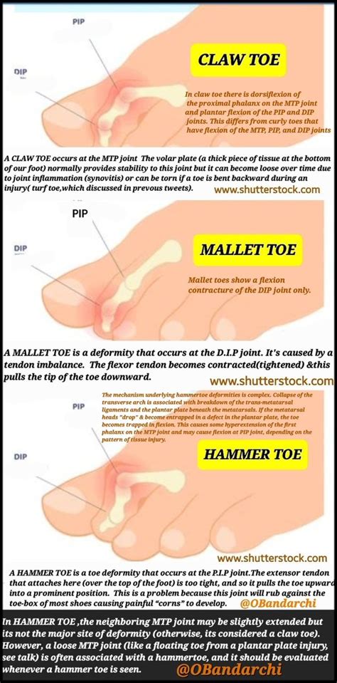 Mallet Toe Vs Hammer Toe