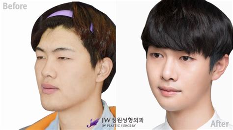 Korean V Line Surgery Where Is The Best V Line Surgery Clinic In
