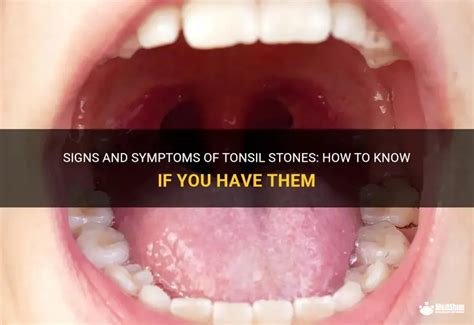 Signs And Symptoms Of Tonsil Stones How To Know If You Have Them Medshun