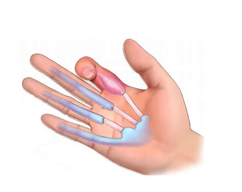 腱鞘炎是怎么回事？ 标件库