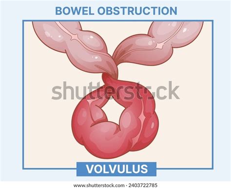 Bowel Obstruction Volvulus Intestine Twists Around Stock Vector Royalty Free 2403722785