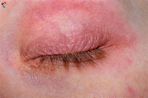 Understanding Watery Eyes Causes Symptoms And Treatments The