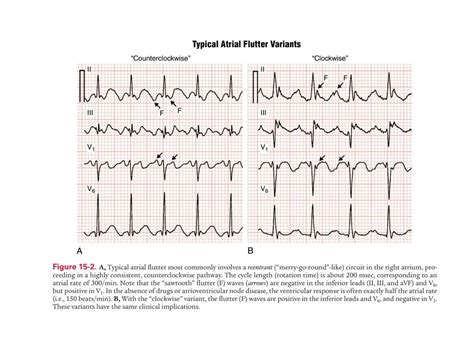 Atrial Fib And Atrial Flutter Pptx