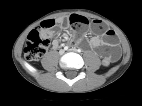 Ingested Foreign Body Uams Department Of Radiology