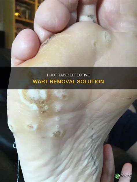 How Duct Tape May Help Plantar Warts What The Evidence Shows Shuncy