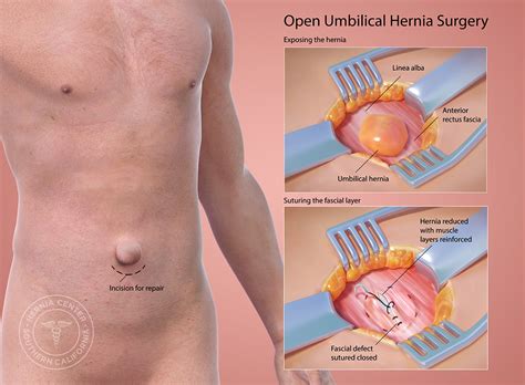 Umbilical Hernia Treatment Pasadena Orange County Riverside Ca