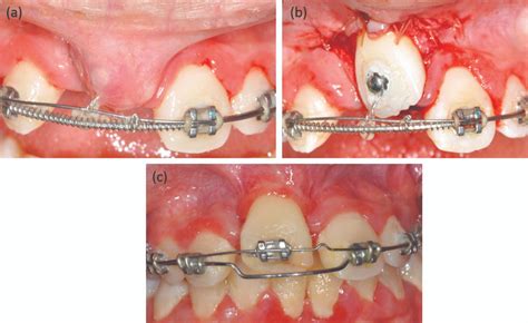 Soft Tissue Management Of Labially Positioned Unerupted Teeth Dentowesome