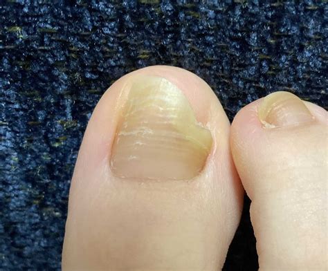 爪甲剥離④ 爪甲剥離治療経過記録 楽天ブログ