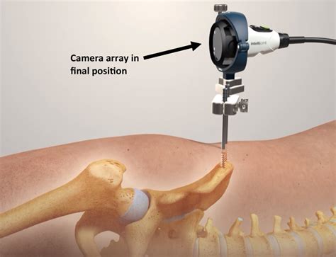 Intellijoint Hip® Camera Array In Position On Pelvic Tracker Platform