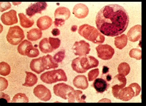 L3 Normocytic Normochromic Anemia Flashcards Quizlet