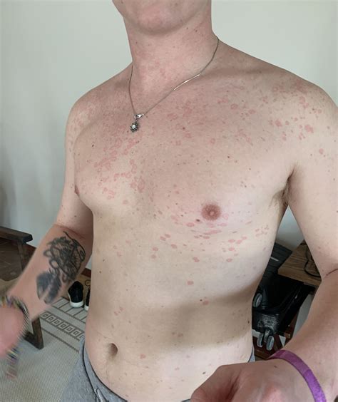 Tinea Versicolor Chest Steroid Resistant Rash Dermatology Advisor