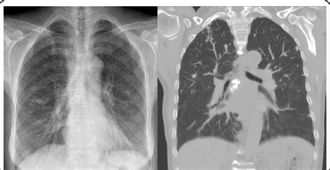 Pa Chest Radiograph Left Demonstrates Bilateral Diffuse Miliary Download Scientific Diagram