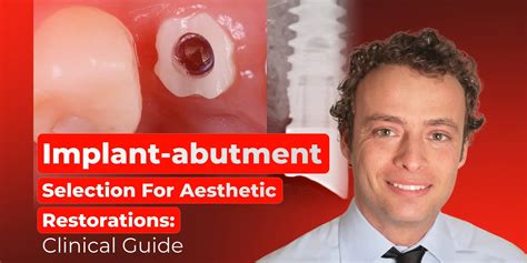 Online Course Implant Abutment Selection For Aesthetic Restorations