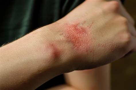 Itchy Reaction Caused By A Mosquito Bite Showing A Person Scratching The Red Premium Ai