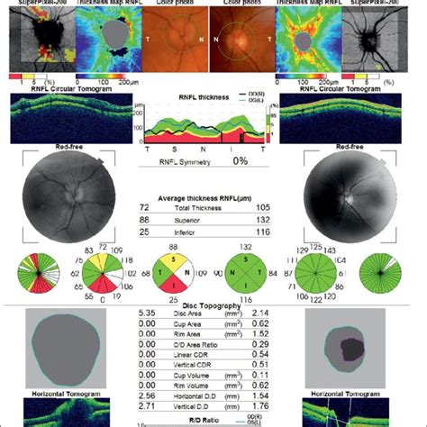Pdf Unilateral Optic Disc Swelling As A First Sign Of Optic Nerve