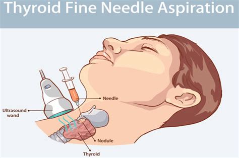Multinodular Goiter Symptoms Causes Diagnosis And Treatment