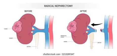 19 Partial Nephrectomy Görseli Stok Fotoğraflar Ve Vektörler