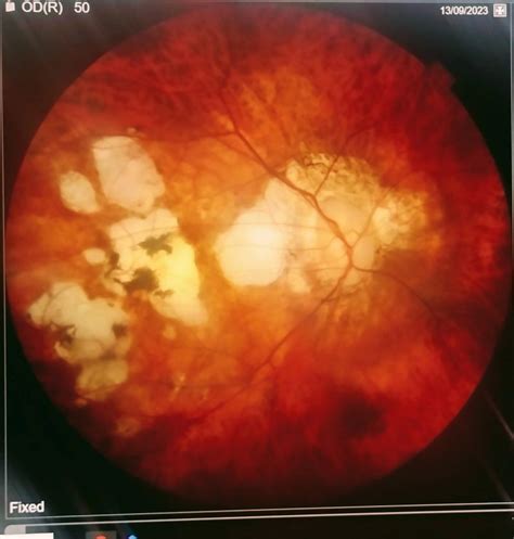 Pathologic Myopia A Subgroup Of Myopia Sudipto Banerjee Posted On