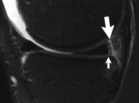 Expert Meniscus Tear Surgery In Surrey