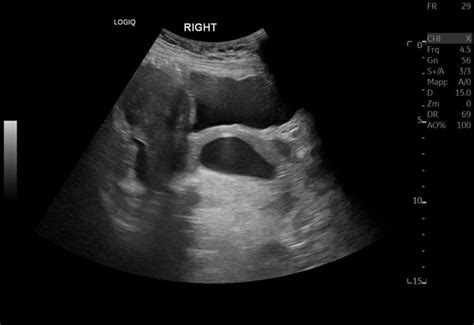 Gartner Duct Cyst Pictures Of S