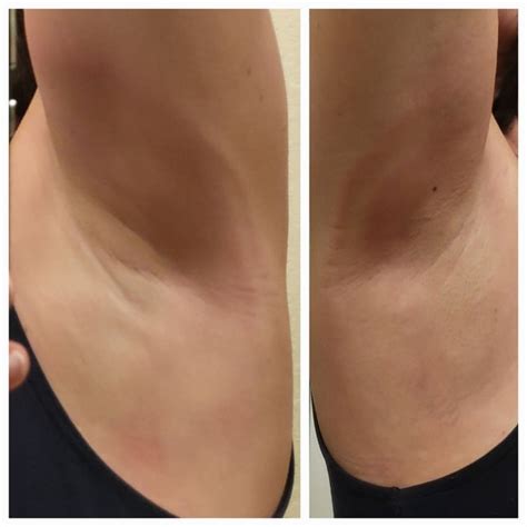 Seasonal Ring Around Armpit Rash Rhistamineintolerance