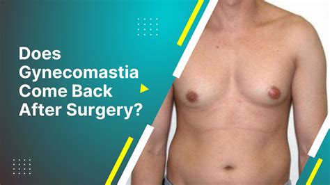 Does Gynecomastia Come Back After Surgery 2026