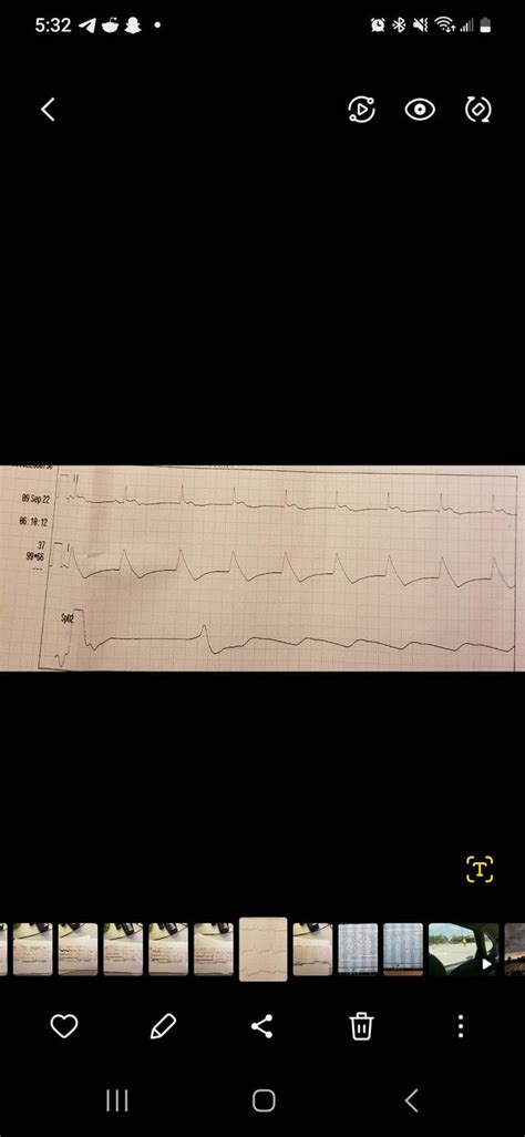 14 Yof Cc Syncope And Chest Pain Rekgs