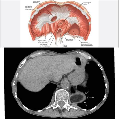 Are Bochdalek Hernias Common Right Sided Bochdalek Hernia In An Adult With Hepatic Jdkjs