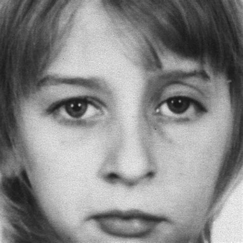 Pdf Bilateral Linear Scleroderma “en Coup De Sabre” Associated With