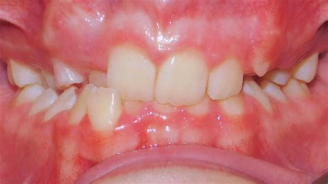 Class I Deep Bite Clincheck Ninja Orthomasterclass