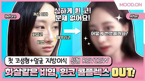 첫코수술이랑 얼굴지방이식 진행할게요｜아 매부리코 휜코 화살코교정 기능코 비염개선 이마지방이식 앞볼지방이식 한 큐에 갈게요😎😎 Youtube