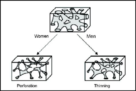 Gender Differences In Pattern Of Trabecular Bone Loss Resulting In